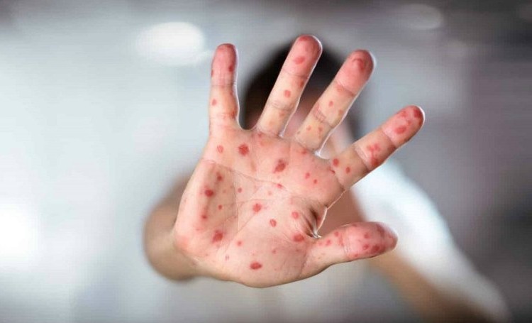 Những Điều Cần Biết Về Bệnh Rubella Và Cách Phòng Bệnh